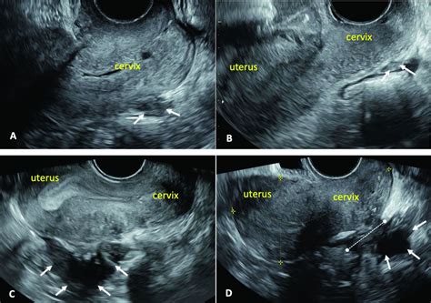 Ultrasound And Its Role In Diagnosing And Managing Endometriosis Mdedge