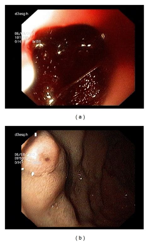 Bleeding Ectopic Varices As The First Manifestation Of Portal Hypertension Pmc