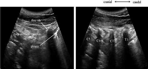Demonstration The Step Of Us Ps To Identify C7 Transverse Process Download Scientific Diagram