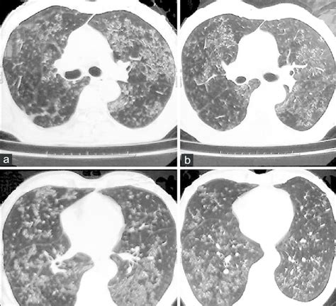 Hrct Scan Of Thorax Showing Bilateral Reticulonodular Opacities D C Download Scientific Diagram