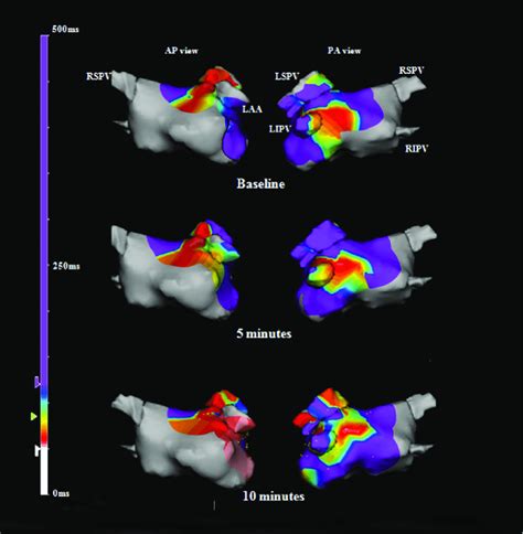 Representative Complex Fractionated Atrial Electrogram Cfae Maps Download Scientific Diagram