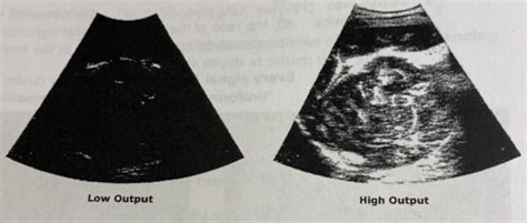 Pulsed Echo Instrumentation Flashcards Quizlet