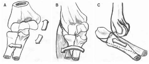 Sequential Scenario Of The Most Common Posterolateral Dislocation Of Download Scientific