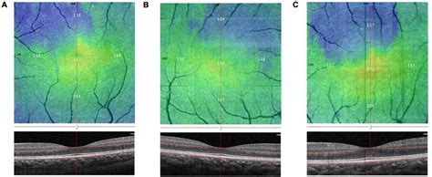Comparison Of The Outer Plexus Layer To Bruchs Membrane Opl Brm