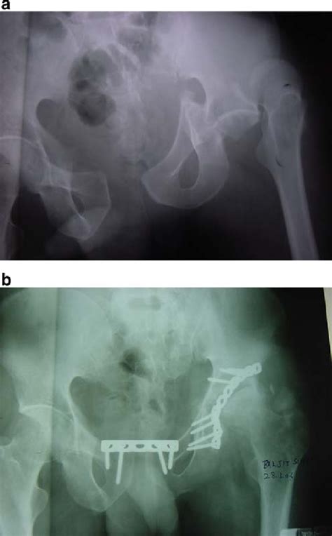 A Pre Operative And B Final Follow Up X Ray Of A Transverse Acetabular Download Scientific