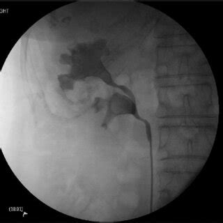 Right Retrograde Pyelogram As Part Of Pre Operative Workup And Download Scientific Diagram