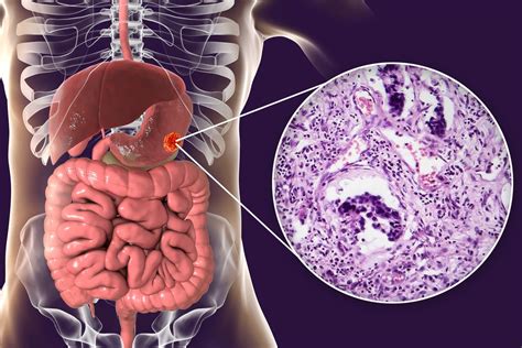 Gastric Cancer Biomarker Nearly 90 Accurate Even In Early Stages