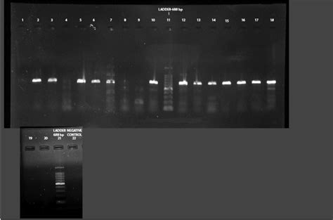 Distribution Of Ctx M Tem Shv Beta Lactamase Gene Among The Klebsiella Pneumoniae Clinical