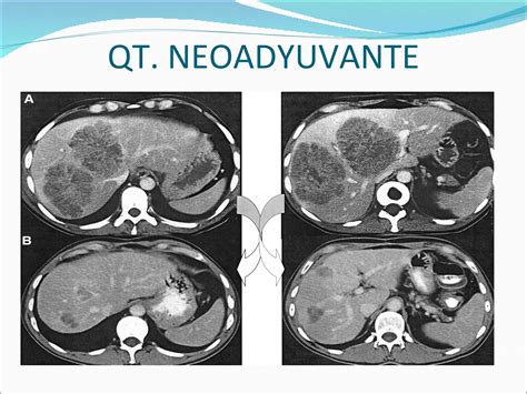 Tratamiento De Metastasis Hepatica De Origen Colorrectal Connie Ppt