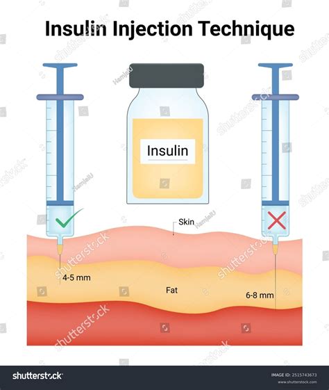 Skin With Insulin Injection Over 255 Royalty Free Licensable Stock Illustrations And Drawings