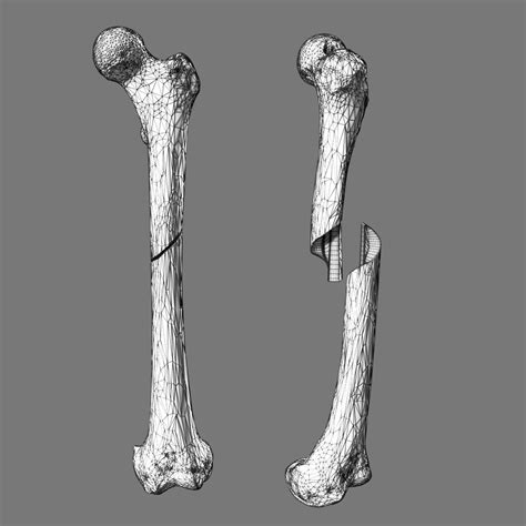 Spiral Fracture Skeleton Labelled Femur 3d Model Superhive Formerly Blender Market