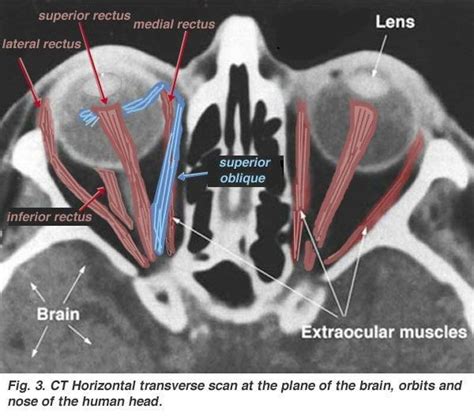 Mri Extra Ocular Muscles Eye Anatomy Gross Anatomy Anatomy
