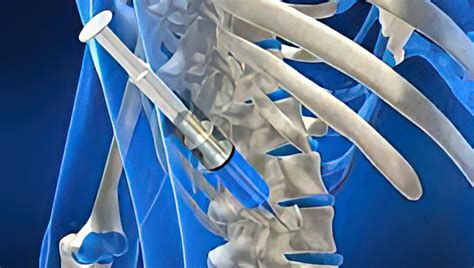 Facet Injections Trimed Spine And Joint