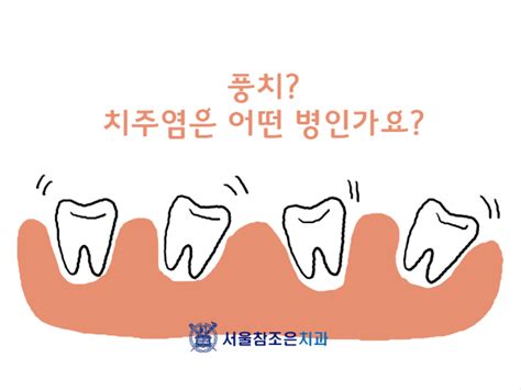 [성수 치과] 풍치 치주염의 모든 것 네이버 블로그