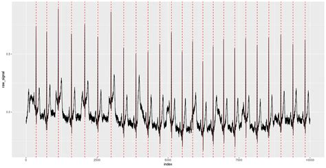 Electrocardiogram Qrs Detection Using Pan Tompkins Algorithm And R Programming Language By