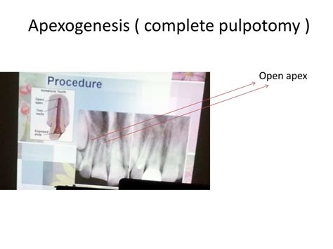Ppt Pulpotomy Powerpoint Presentation Free Download Id 6057226