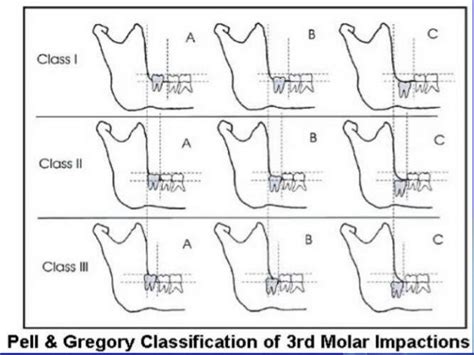Impacted Third Molar Management