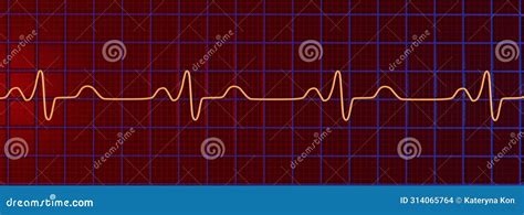 Ecg Of Bundle Branch Block 3d Illustration Royalty Free Cartoon