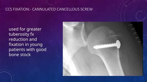 Fracture Of Proximal Humerus Etiopathogenesis Clinical Features And Management Pptx