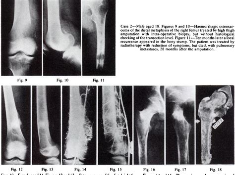 Figure 29 From Local Recurrence After Amputation For Osteosarcoma