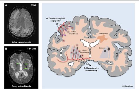 Figure 3 From Cerebral Microbleeds On Magnetic Resonance Imaging And Anticoagulant Associated