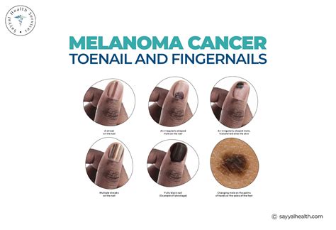 Acral Lentiginous Melanoma Symptoms Causes And Diagnosis