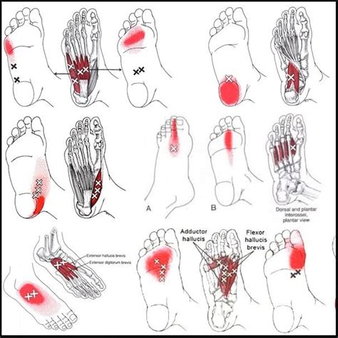 Foot Pain Plantar Fasciitis And Trigger Point Pain El Paso Tx