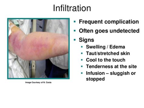 Intravenous Therapy Flashcards Quizlet