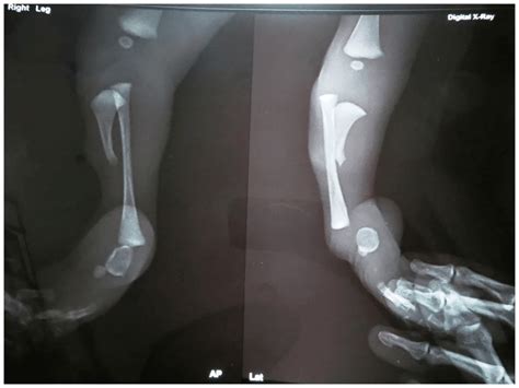 Tibial Hemimelia Causes Symptoms And Treatments Trishla Ortho