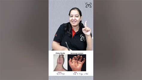 1 Minute Learning Osler Node And Janeway Lesion Medlive Dr Priyanka Sachdev Youtube
