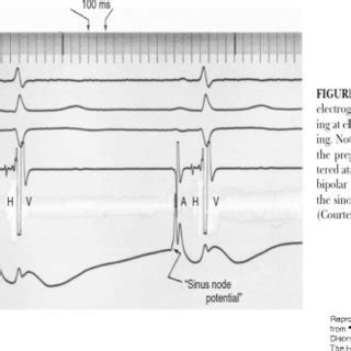 Anatomy And Histology Of The Sinus Node On The Left Sinus Node Is Download Scientific Diagram