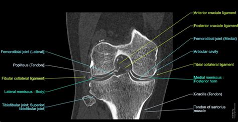 Anatomy Of The Knee Ct Arthrography E Anatomy Images And Photos Finder