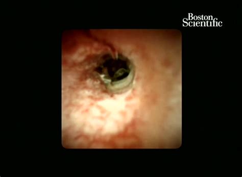 Claudio Zulli On Linkedin Cholangioscopy With Spyglass System Showing