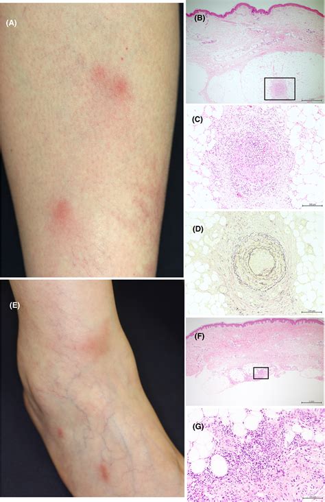 Erythema Nodosum Legs