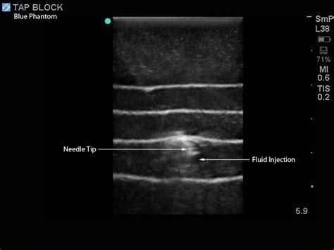 Tap Nerve Block Ultrasound Training Model Bp2001 Tap Bt