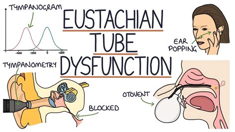 Understanding Eustachian Tube Dysfunction Youtube