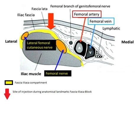 Fascia Iliaca Block Fib In Elderly Patients Outside The Operating Room For Pain Management Of