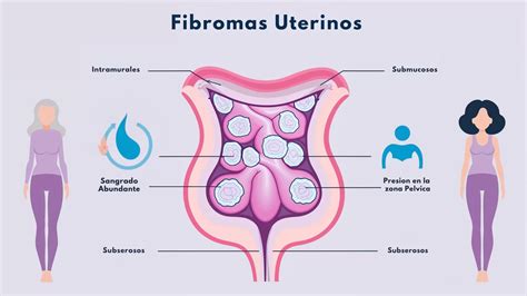 Fibromas Uterinos Una Guía Completa Hemeranixpe