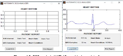 Figure 16 From Design And Simulation Of Electrocardiogram Circuit With Automatic Analysis Of Ecg