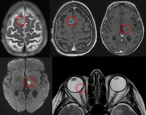 Mri Brain Showing Disseminated Cerebral Nocardiosis And Choroidal