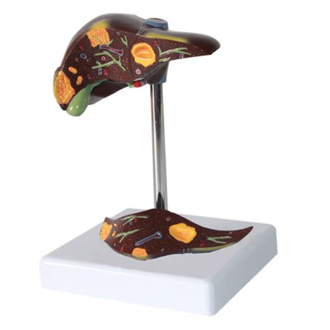 Buy Body Model Liver Pathology Model Anatomical Pathology Model Of