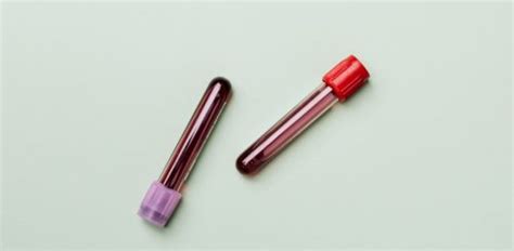 Hdl Colesterol Scazut Cum Putem Creste Nivelul De Colesterol Bun