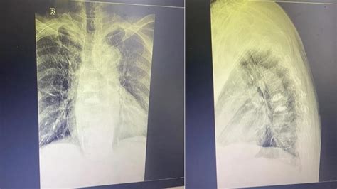 病例分享丨75岁老人陈旧性骨折胸背部疼痛俩月如何治疗 东方养生频道 东方养生