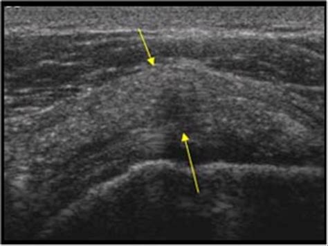 Musculoskeletal Joints And Tendons 61 Shoulder Case 6118 Bursa