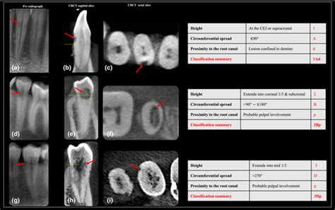 External Cervical Resorption A Three‐dimensional Classification Patel 2018 International