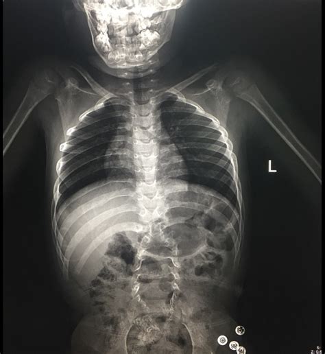 Ecografia Spina Bifida