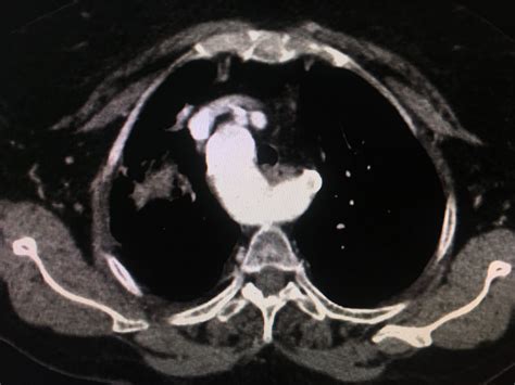 Right Sided Aortic Arch With Arsca Kommerell Diverticulum