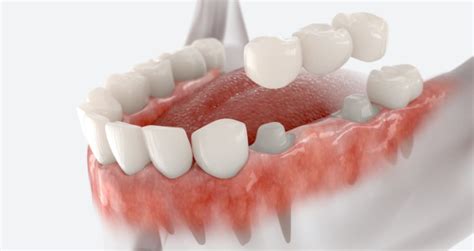 Fix Gap Between Crown And Gum Solutions Tips