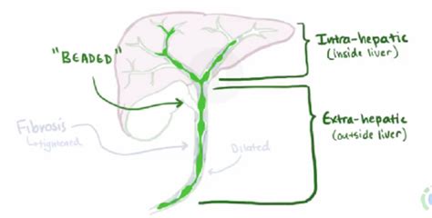 Primary Sclerosing Cholangitis PSC Flashcards Quizlet