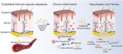 Figure 1 From M2 Macrophage Polarization In Systemic Sclerosis Fibrosis